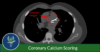 Coronary Calcium Scoring - Capitol Imaging Services