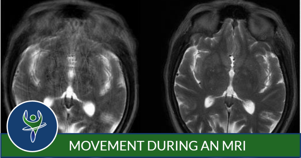 Movement During MRI - Capitol Imaging Services