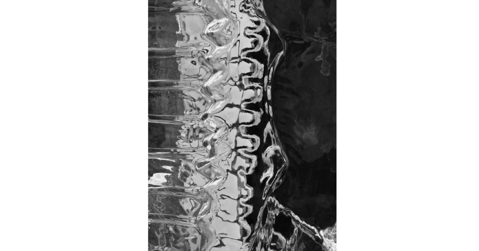 What is Cauda Equina Syndrome? - Capitol Imaging Services